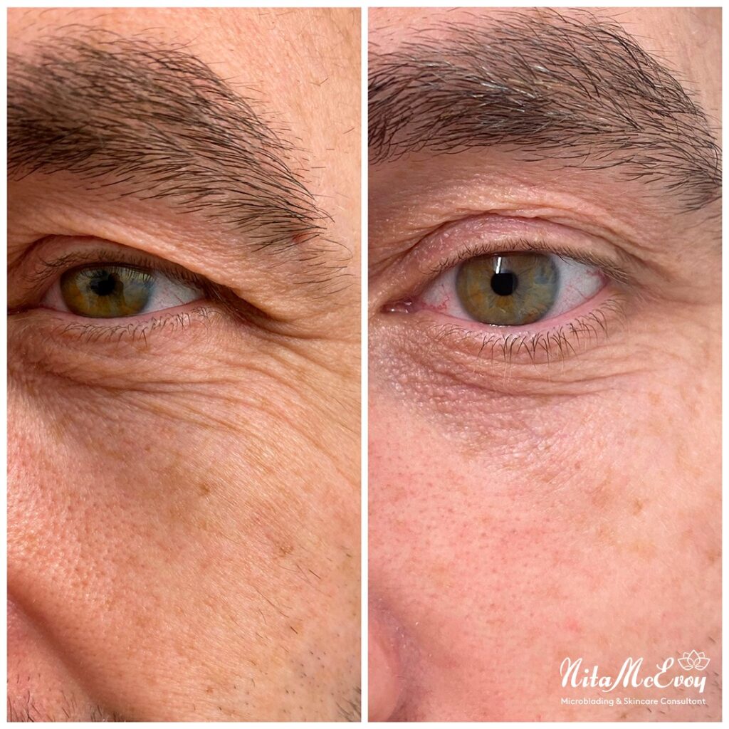 Tear Trough Filler – The Best Treatment for 21st century Men ...