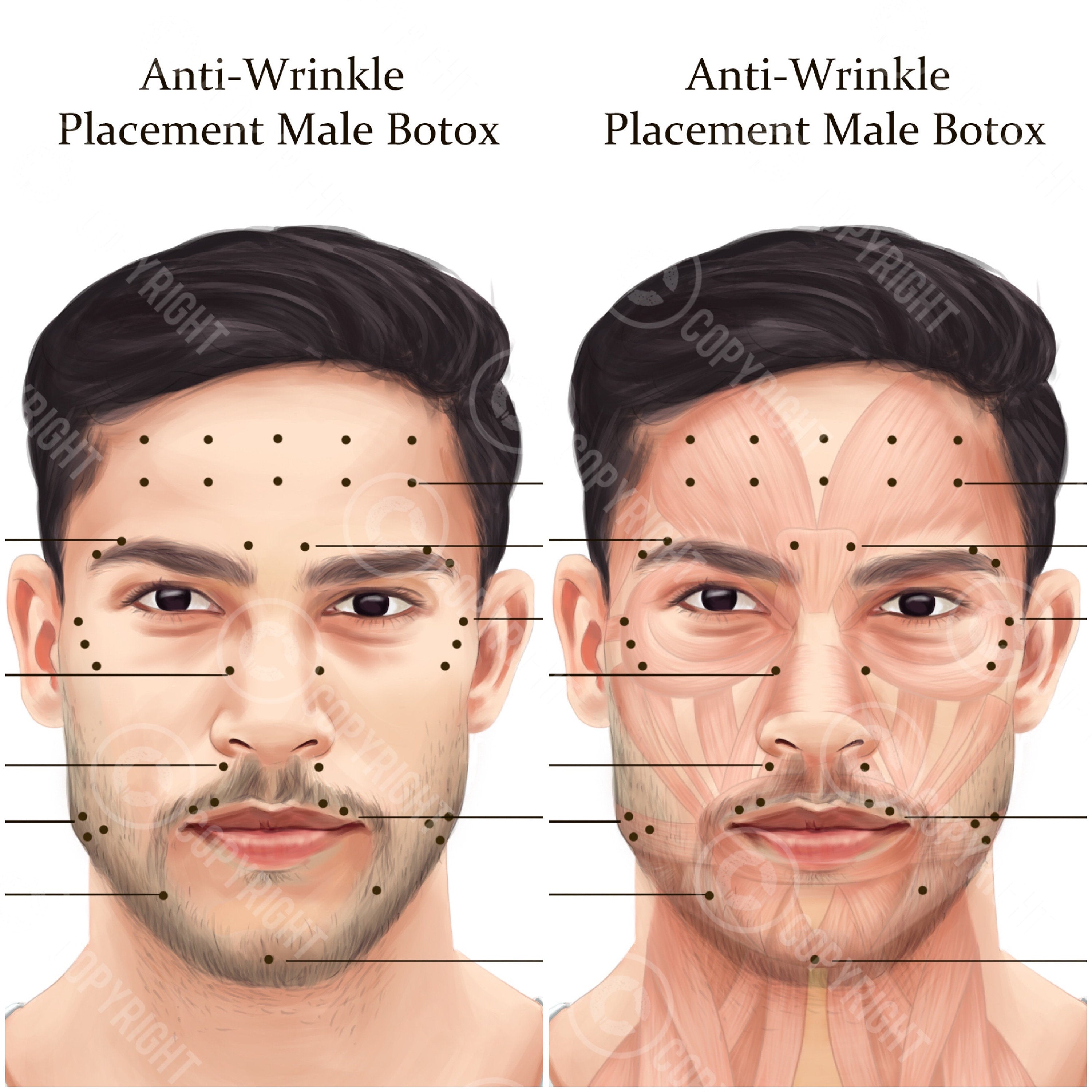 Male Anti wrinkle Injection Points Bundle Daniel Digital Download