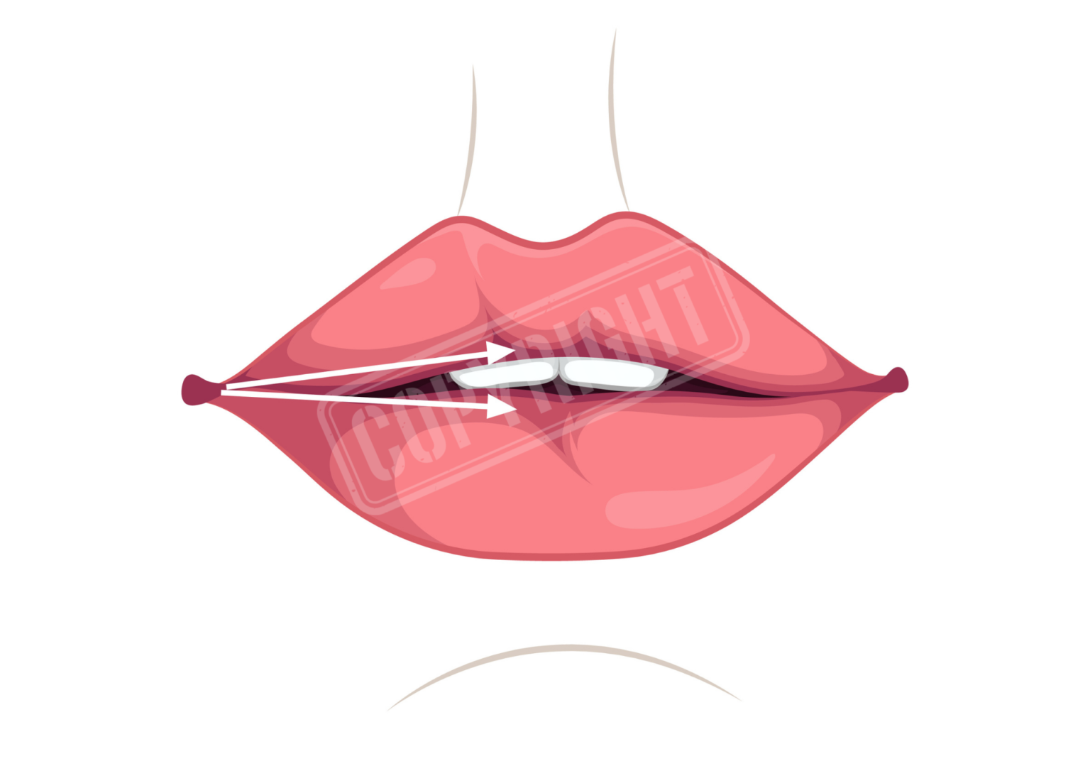 Fundamental Lip Filler Injection Techniques Digital Download - Nitamcevoy.com