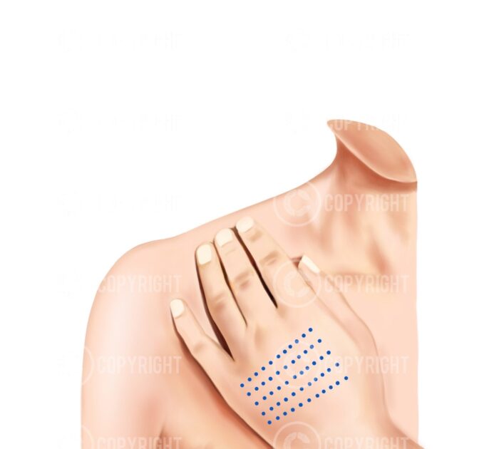 Mesotherapy Nappage Injection Pattern Bundle Sakura Digital Download ...